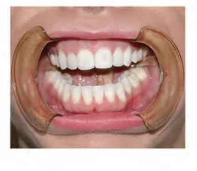 Intraoral Cheek Retractors | DentSupplier